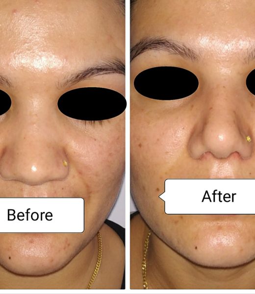 Best Nose Job/ Nose Reshaping/ Rhinoplasty in Nepal/ Asia- Dr Nayan