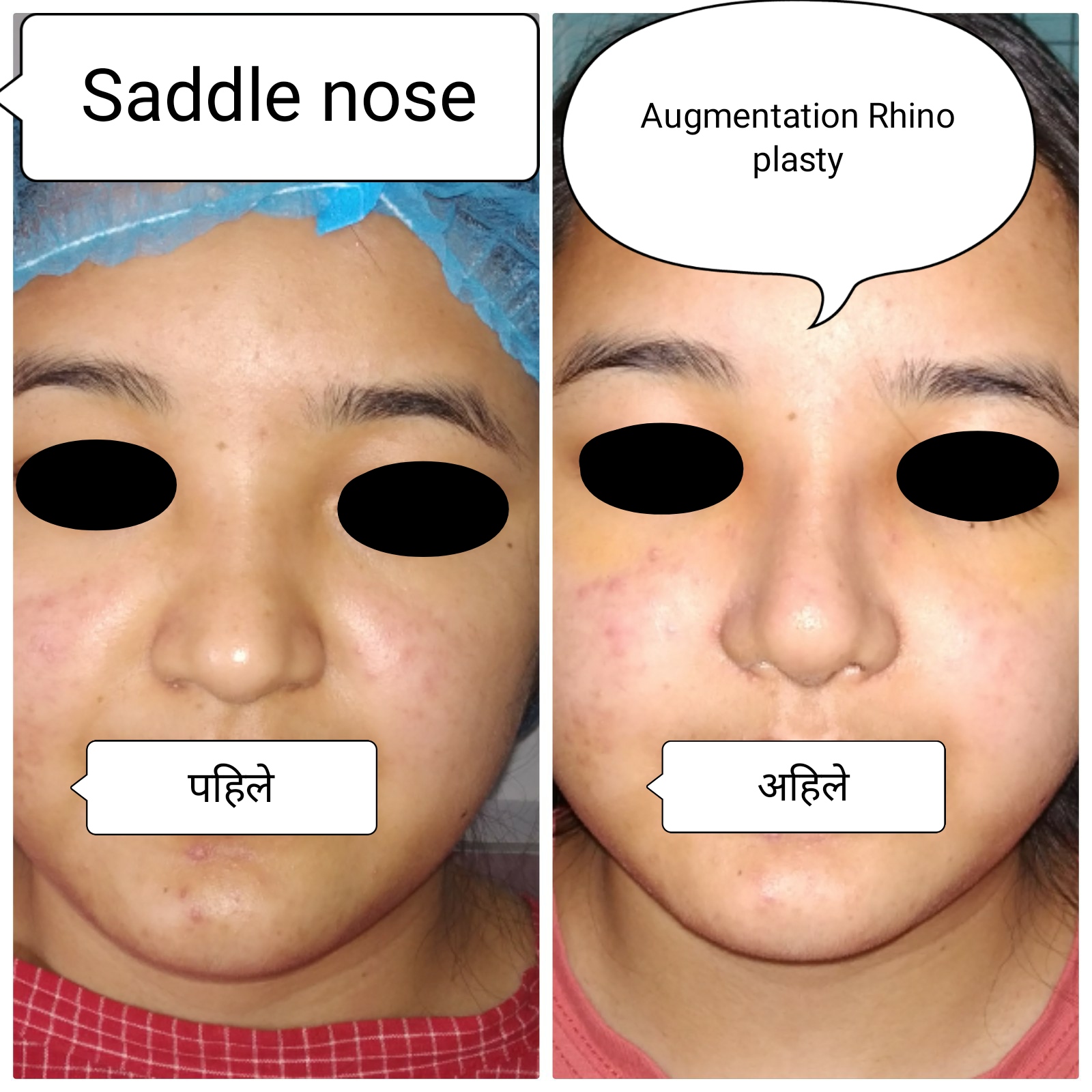Septorhinoplasty among Patients who Visited the Outpatient Department ...