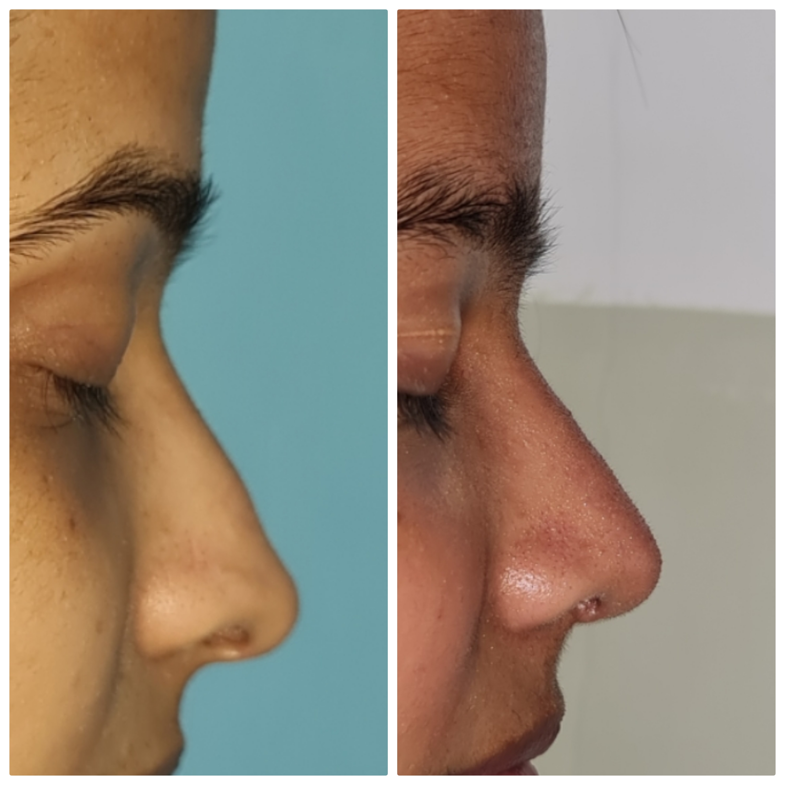 Rhinoplasty Preservation hump nose Nepal